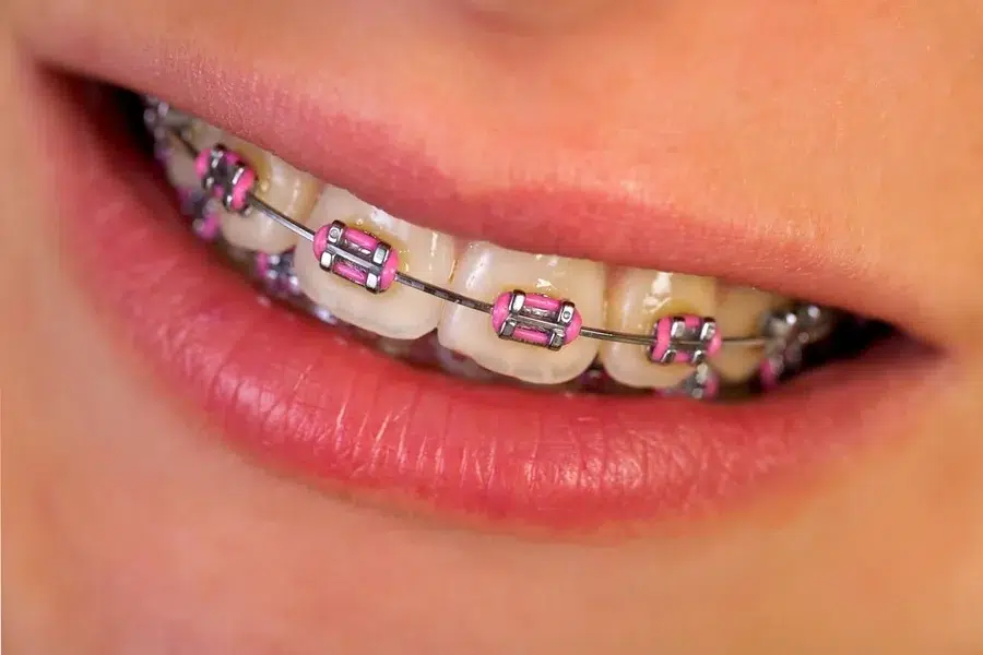 How Surrey Orthodontists Use Metal Braces to Correct Bite Issues