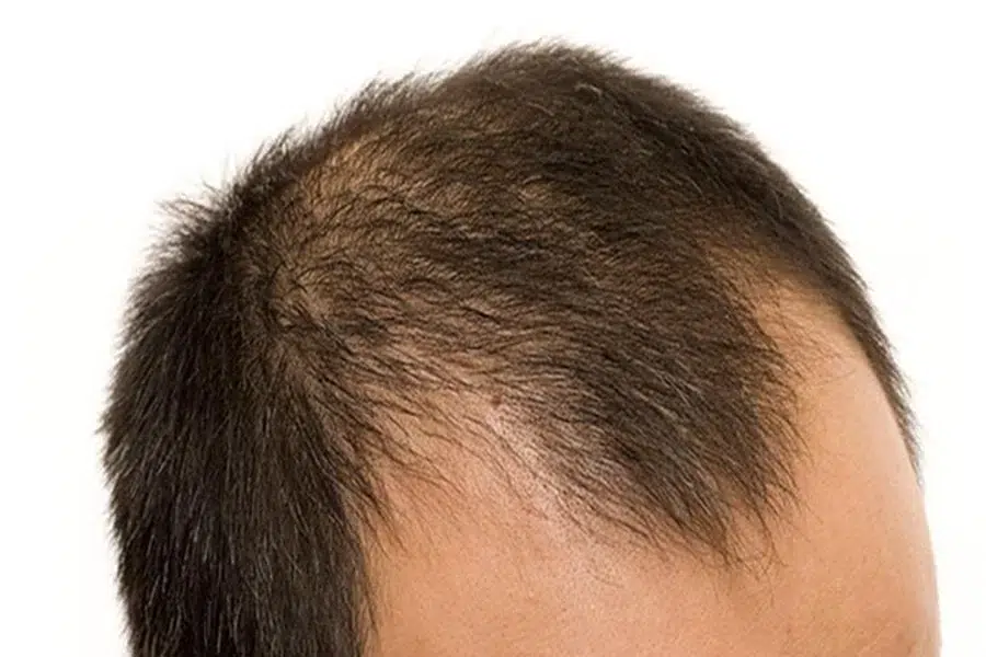 Changes in Male Hair: What They Might Mean for You