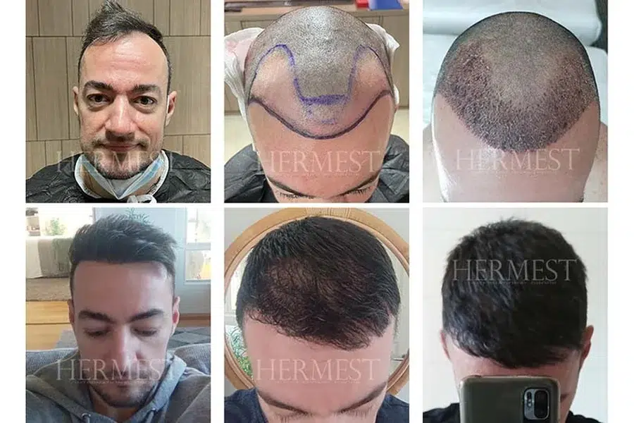 The Ultimate 2026 Guide: Best Hair Transplants in Turkey for Texas Patients
